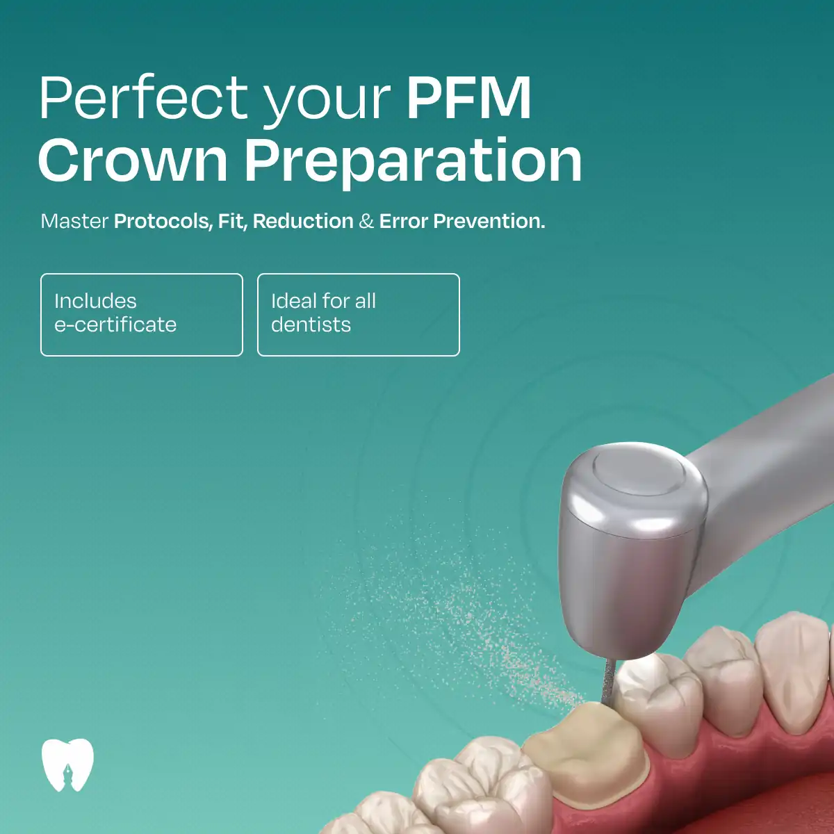 PFM Preparation for Molar